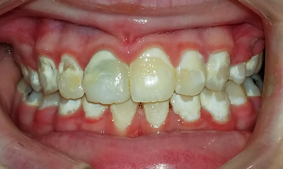 What is decalcification and how do I prevent it?